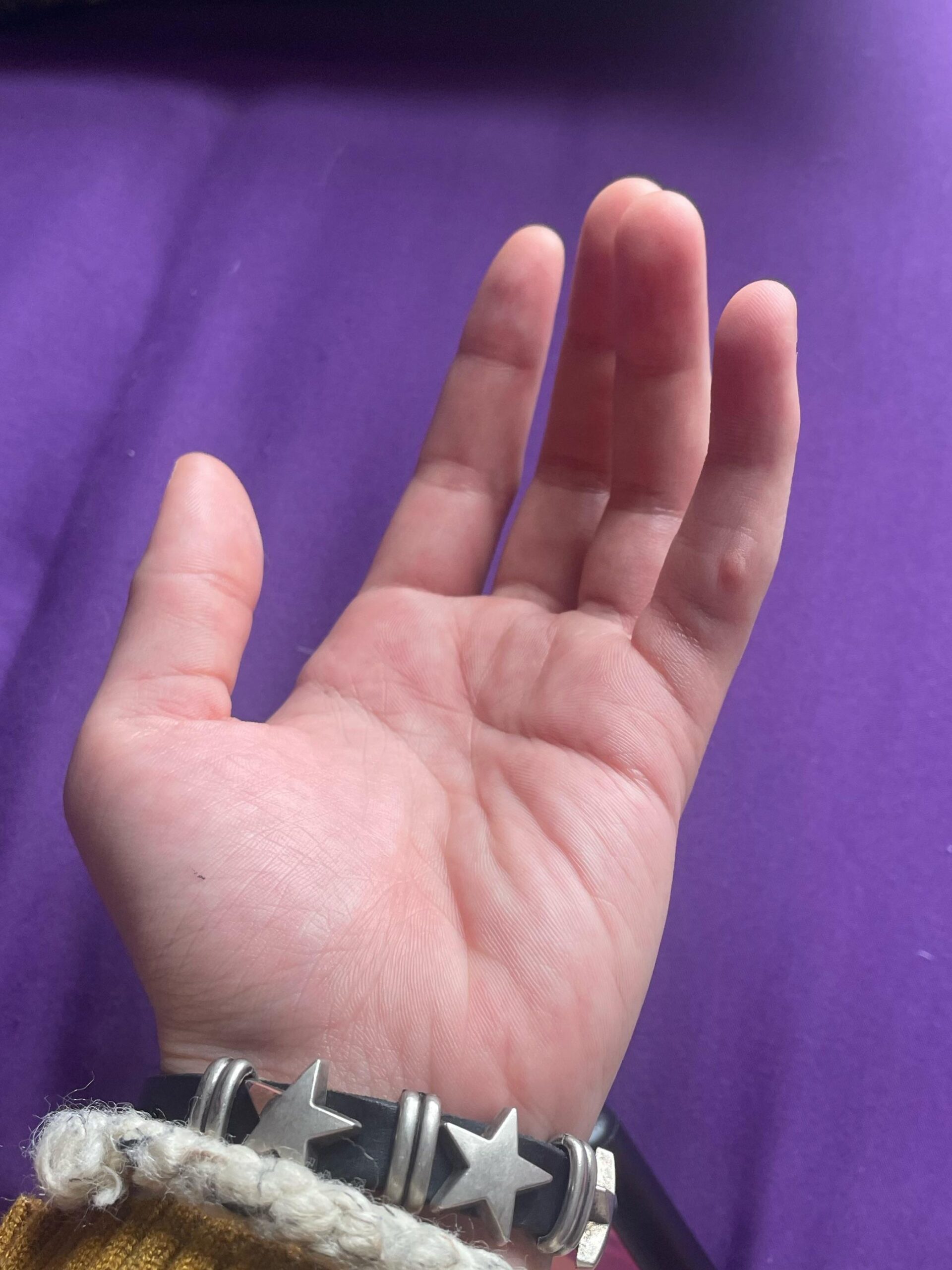 I was born with 6th “fingers” on each pinky… but they were removed and ...