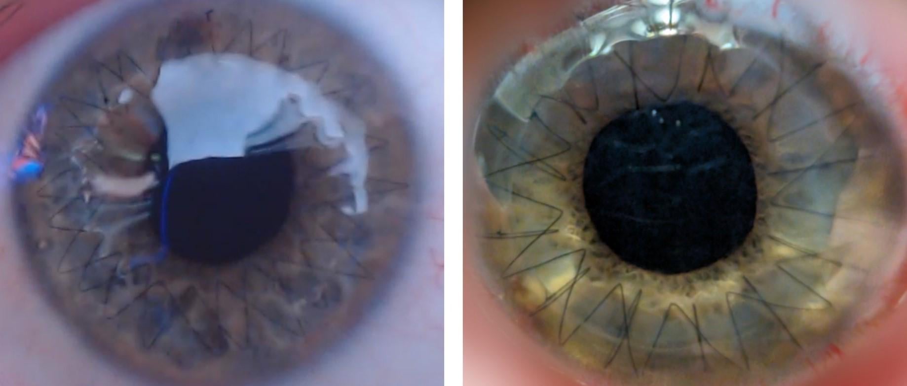 The differences between the stitches in my eyes from my first(left) and ...