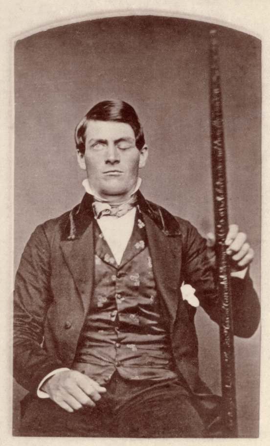Phineas Gage, a railroad construction worker, survived a traumatic ...