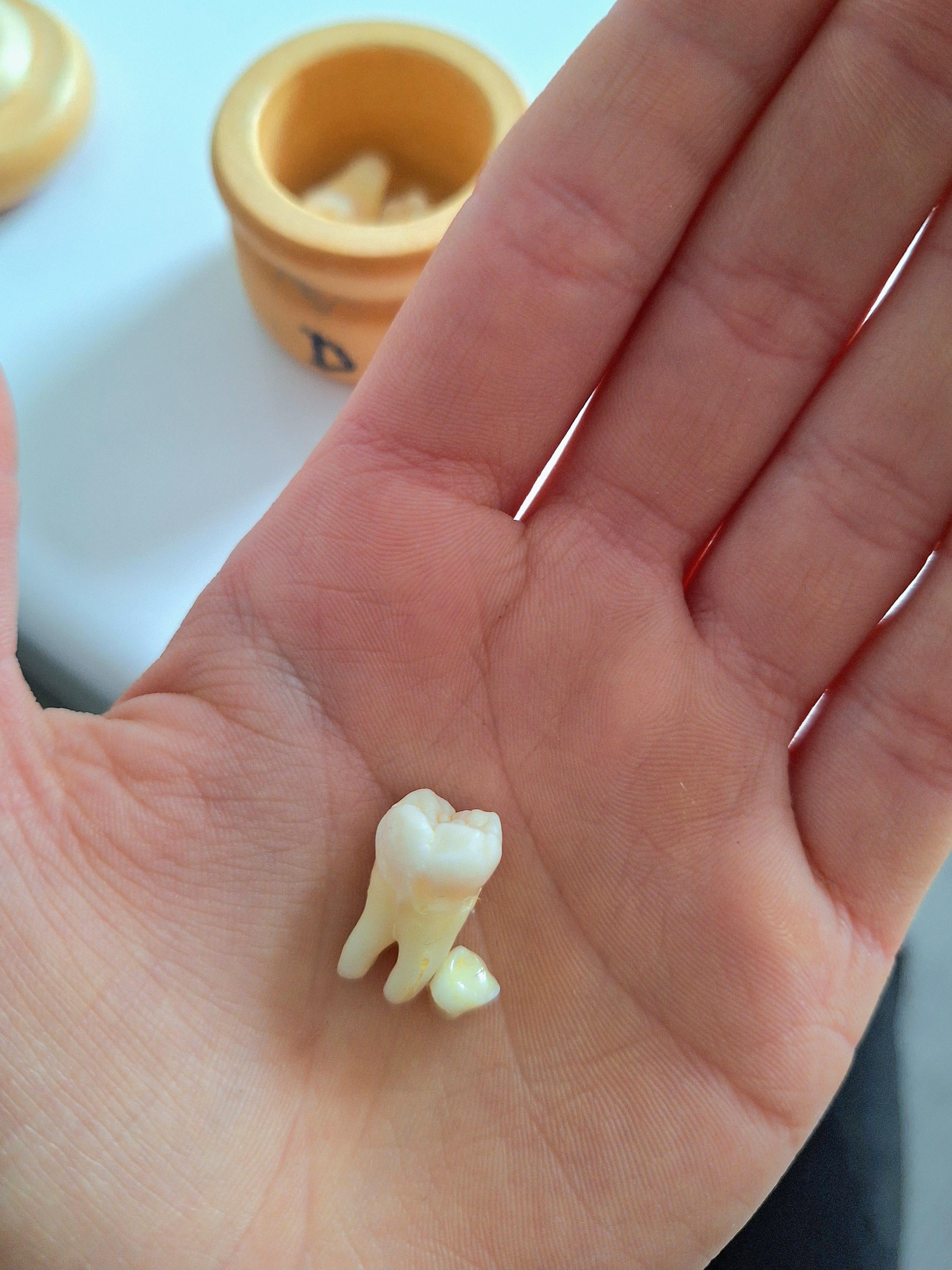 My biggest wisdom tooth next to my smallest baby tooth - USLUCK