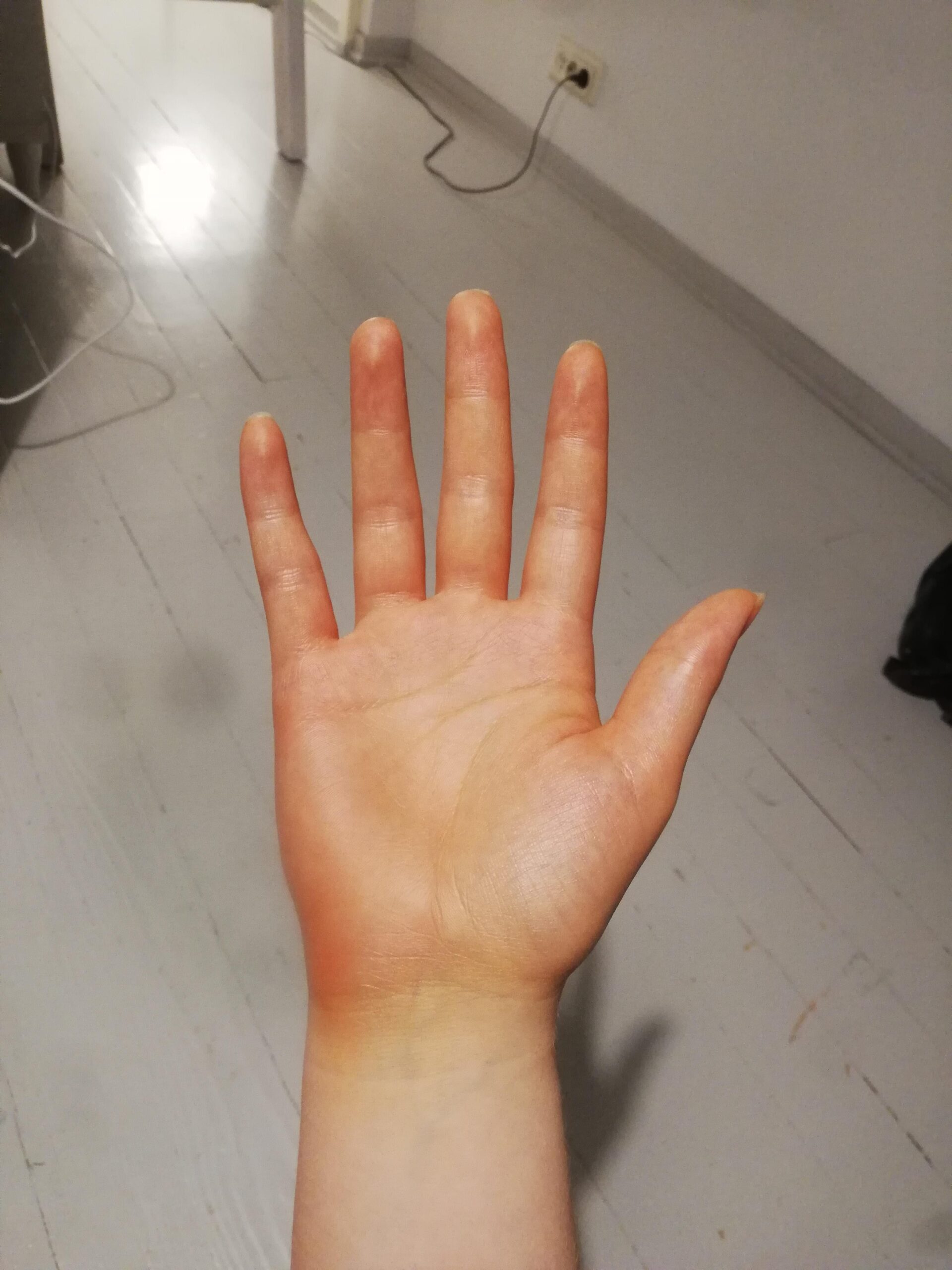 The palms of my hands have turned orange from taking a high dose of ...