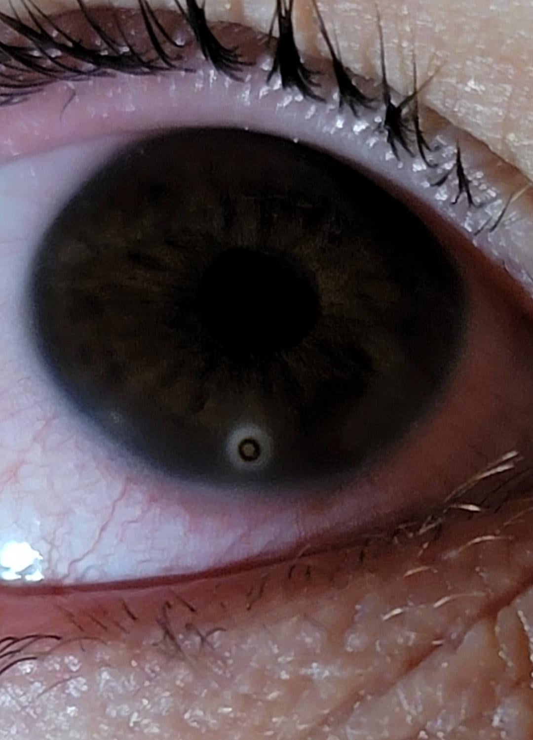 I got a piece of metal stuck in my eye and it left a rust ring after it ...