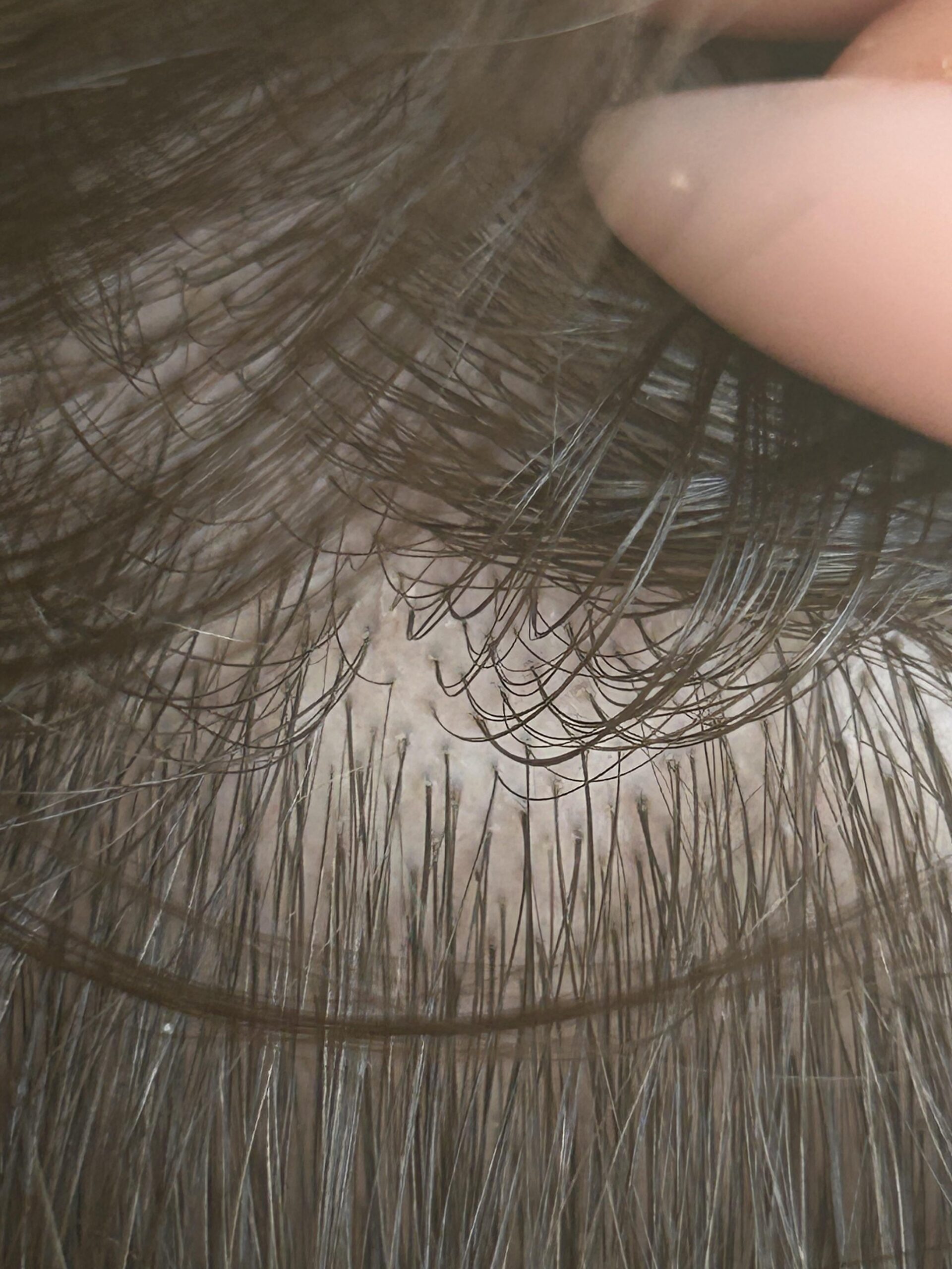 My husbands hair has double/triple hairs growing out of one follicle ...