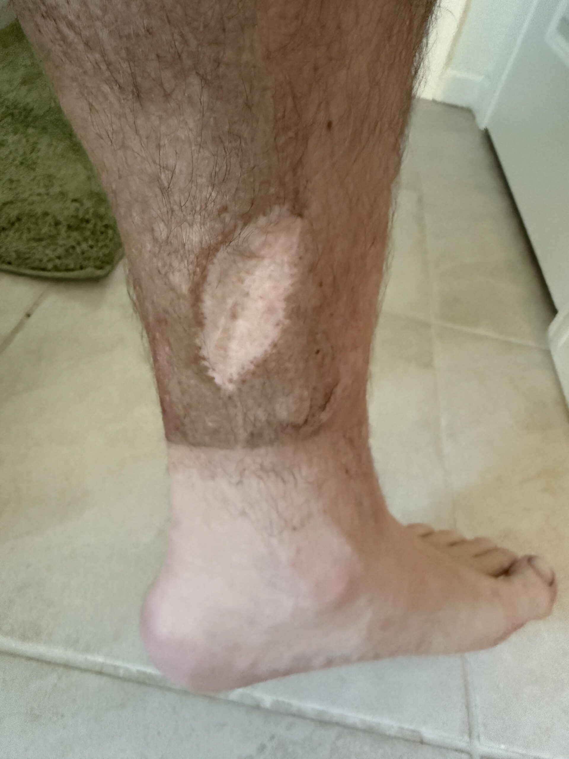 My husband broke his leg when he was younger and got a skin graft; it ...